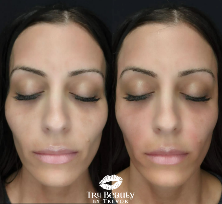 Before And After Gallery | Tru Beauty By Trevor